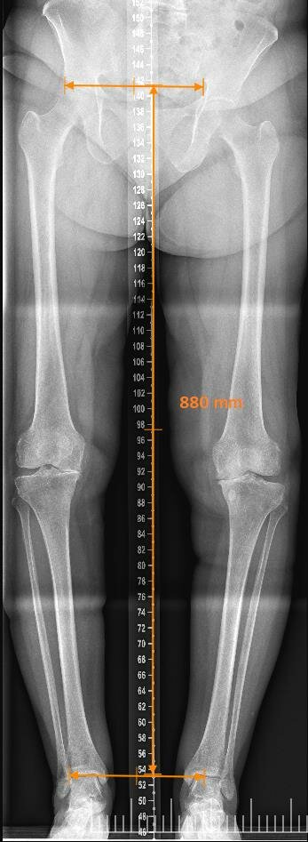 Radiografía Panorámica de Miembros Inferiores en Lima Norte – Medscope - Medscope